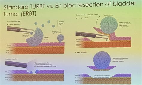 Suo 2024 New Approaches To Nmibc Surgery