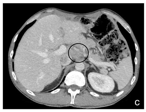 Luca Parmeggiani Bologna Cake Peritoneal Carcinosis What The