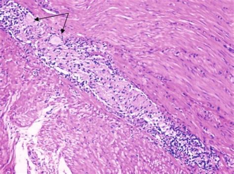 Myenteric Plexus With Severe Inflammatory Infiltrate I Open I