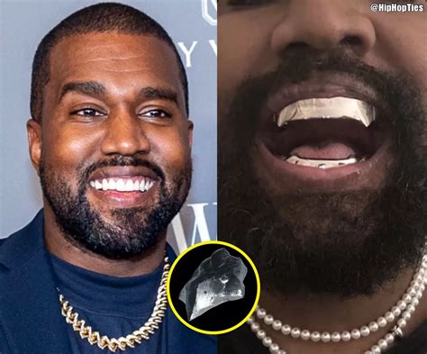Kanye West Teeth The Real Story Behind The Trend Parla Clinics