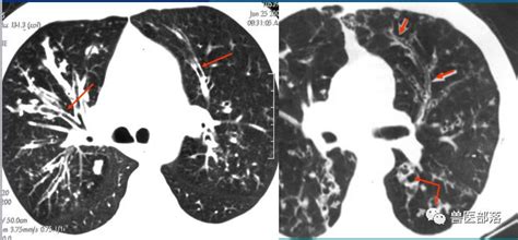 胸部常见ct 十大征象的诊断及应用