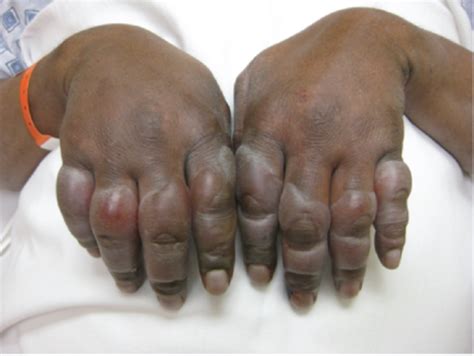 First Degree Frostbite