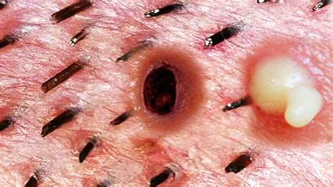 Pimple Poppers Blackheads And Zits Under The Microscope Preview Youtube