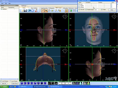 3d Radial Asymmetry Analysis Of 3dmd Face Scan Download Scientific