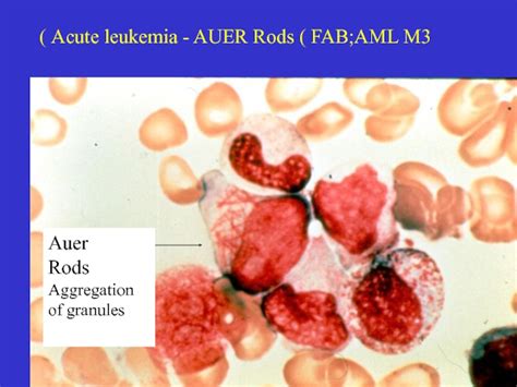 Acute Myeloid Leukemia