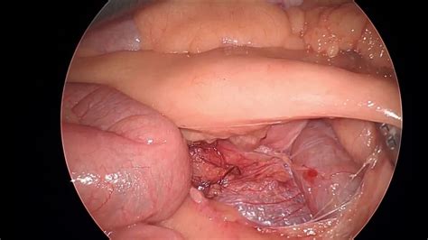 Laparoscopic Right Hemicolectomy By Nezar Jrebi Md And Jay Redan Md