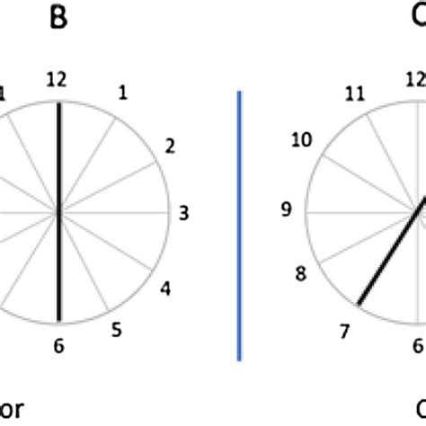 The Clock Dial Test For Astigmatism A When The Horizontal Meridian