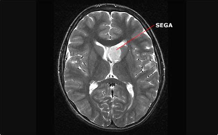 How Tsc Affects Brain Anatomy