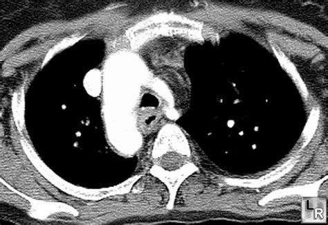 Learning Radiology Right Aortic Arch