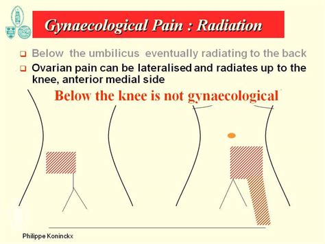 Ovary And Appendix Location