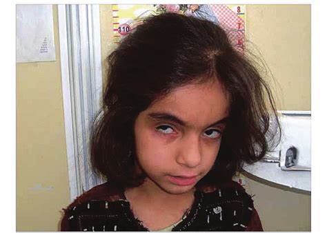 The 10 Years Old Girl With Developmental Delay Ftt Mental Retardation