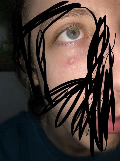 This Started Off Looking Like A Small Pimple Two To Three Days Ago Its Not Usually As Big As