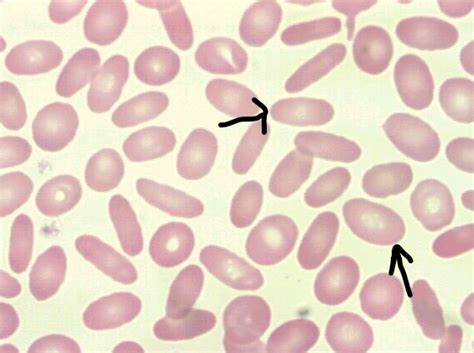 Alteraciones Morfologicas De Los Eritrocitos Mapa Mental
