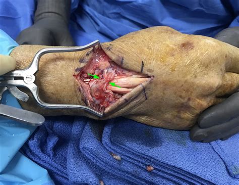 Stenosing Tenosynovitis Of The 4th Extensor Compartment Radsource