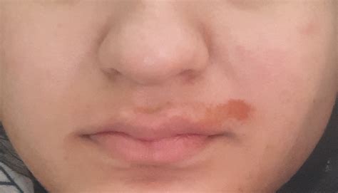 Ask A Dermatologist Online For Waxing Burn Mark On Face