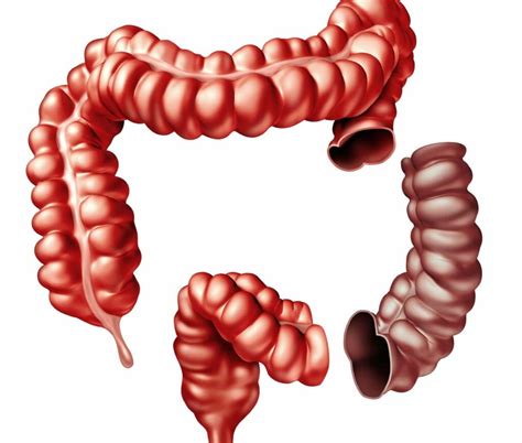 Long Term Colectomy Risk Among Patients With Acute Severe Ulcerative