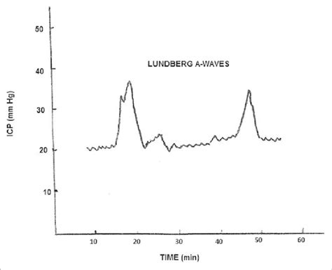 Schematic Diagram Depicting Lundberg A Waves Intermittent Sharp Peaks