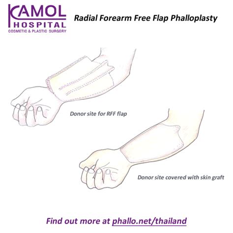 Ftm Phalloplasty In Thailand Dr Kamol Pansritum Ftm Phalloplasty In Thailand Dr Kamol Pansritum