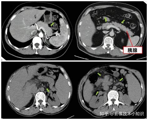 胰腺的变异和病变诊断 知乎
