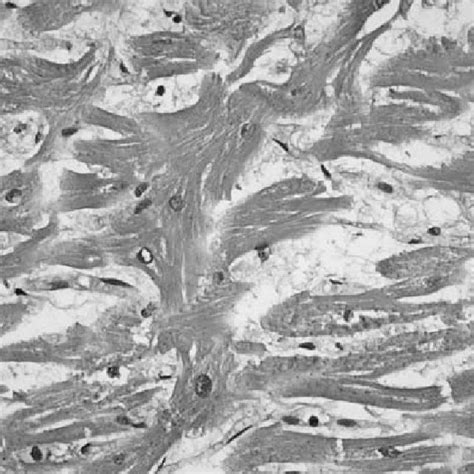 2 Typical Findings On Autopsy Of Histologic Examination Showing