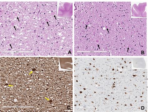 Microscopic Findings Of Case 2 A The Left Inferior Parietal Lobe And B Download Scientific
