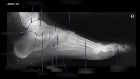 Lateral Foot Diagram Quizlet