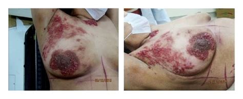 Multiple Subcutaneous Nodules On The Right Chest Wall Download Scientific Diagram