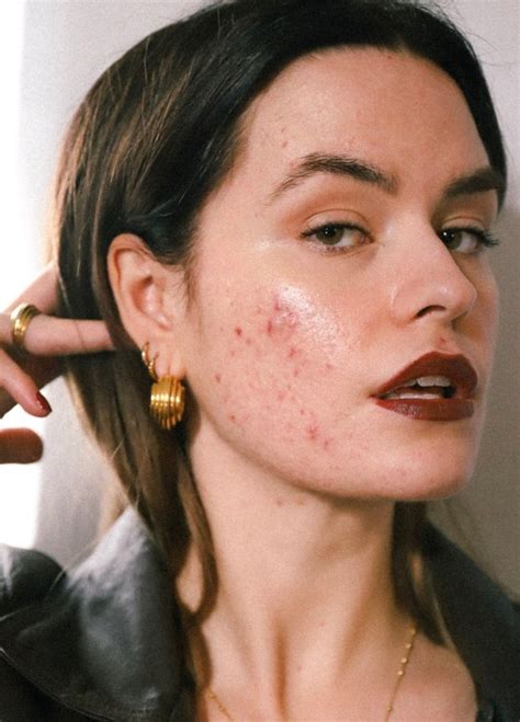 Meet Sofia Grahn The Swedish Influencer Who Wants Us To Embrace Acne Metro News