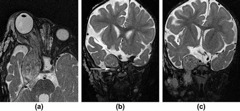 The Trigeminal Nerve An Illustrated Review Of Its Imaging Anatomy And Pathology Clinical