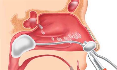 What Is The Best Otc Sinus Infection Medicine