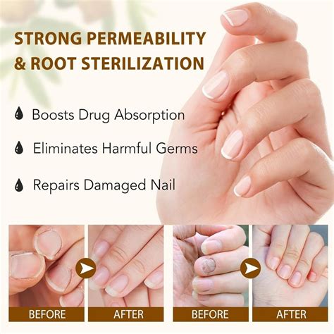 Fungal Nail Treatment Extra Strong Ginger Nail Fungus For Toenails