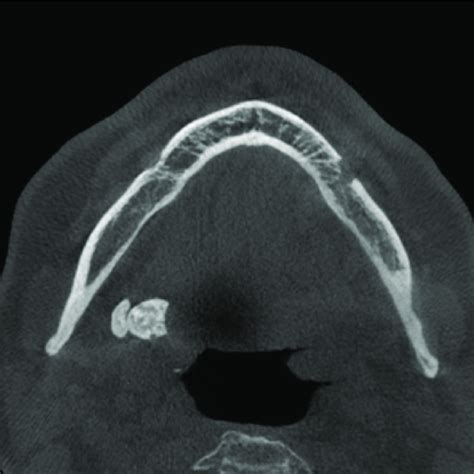 Patient 2 Cone Beam Computed Tomography Image Transverse Sectional