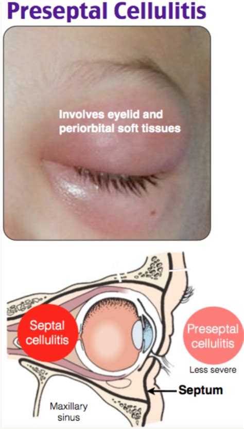Em 3am Periorbital Cellulitis Emdocs