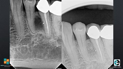 Dont Lose Peripheral Vision Tdo University