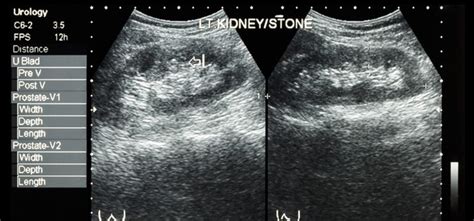 Professor Dr Thomas Enzmann Warum Ultraschall Bei Nierensteinen Doch Das Mittel Der Ersten