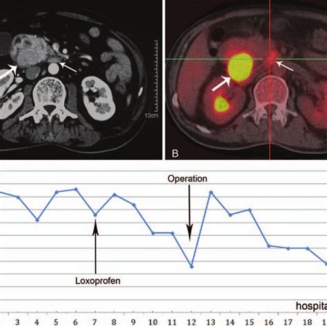 A Abdominal Ct Scan Revealed A Tumor Between The Duodenum And The