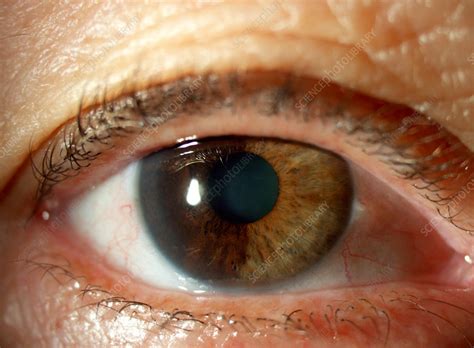Iris Nevus Stock Image C027 2022 Science Photo Library