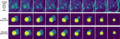 Segmentation Results At Ed Phase Of Cardiac Cycle On Acdc‐17 Testing