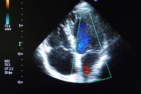 Bubble Test O Test Delle Microbolle Laboratorio Nomentano