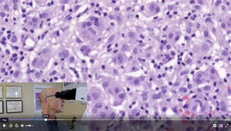 Epithelioid Neoplasm On The Face Juvenile Xanthogranuloma Dermpedia