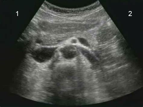 Aorta Transverse Transducer Orientation Image Sonosite Institute For Point Of Care Ultrasound