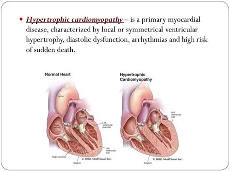 Hypertrophic Cardiomyopathy Online Presentation