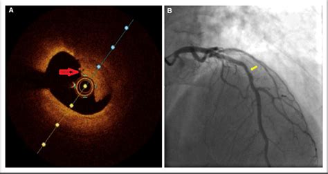 Figure 4 From Role Of Multimodality Imaging In The Assessment Of