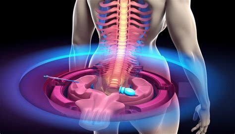 Spinal Decompression For Herniated Disc 3 Ultimate Solution