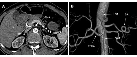 Common Hepatic Artery Radiology