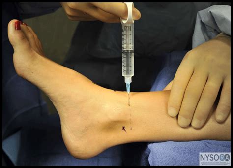 Ankle Block Nysora The New York School Of Regional Anesthesia
