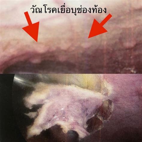 หมอมนูญ ระบุวัณโรคเยื่อบุช่องท้อง พบได้น้อยมาก วินิจฉัยยาก