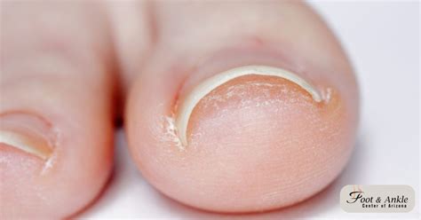 Infected Toe How To Soak And Treat It Properly