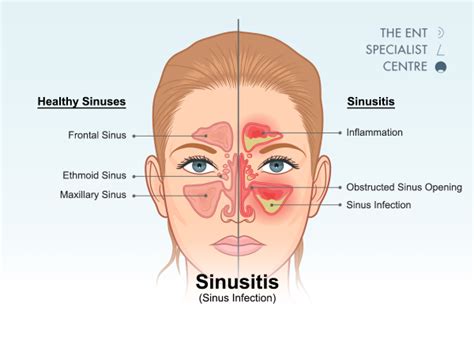 Maxillary Sinus Inflammation