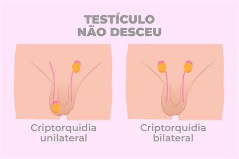 Criptorquidia